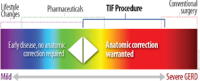 TIF Procedure for Reflux /cTIF - Arizona Centers For Digestive Health