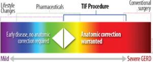 TIF Procedure for Reflux /cTIF - Arizona Centers For Digestive Health