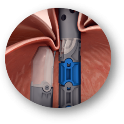 TIF Procedure for Reflux /cTIF - Arizona Centers For Digestive Health