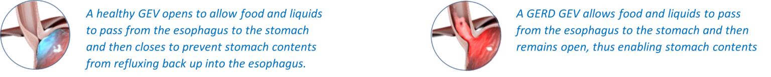 TIF Procedure for Reflux /cTIF - Arizona Centers For Digestive Health