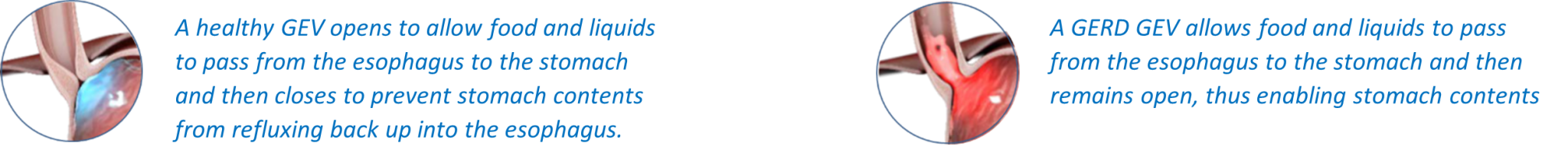 TIF Procedure for Reflux /cTIF - Arizona Centers For Digestive Health